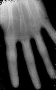 Image of hand shows progress toward proton radiography - News